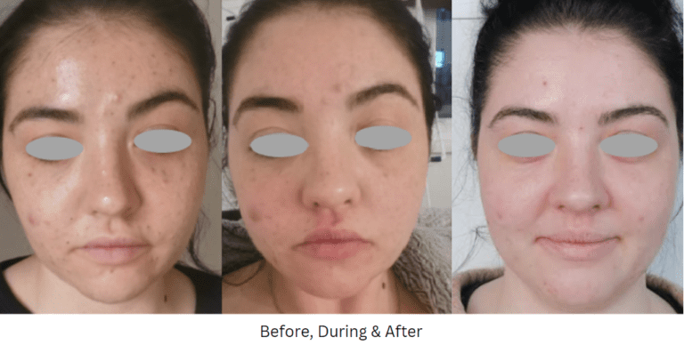 POLYNUCLEOTIDE SKIN REJUVENATION - R&R Aesthetics